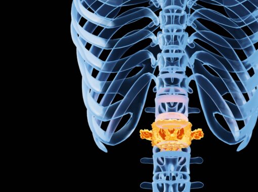 Henry Aryan: Pioneer in Neurosurgical Spine Solutions